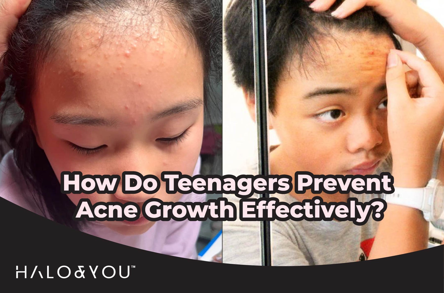 How do teenagers prevent acne growth effectively? | Halo and You | Halo ...